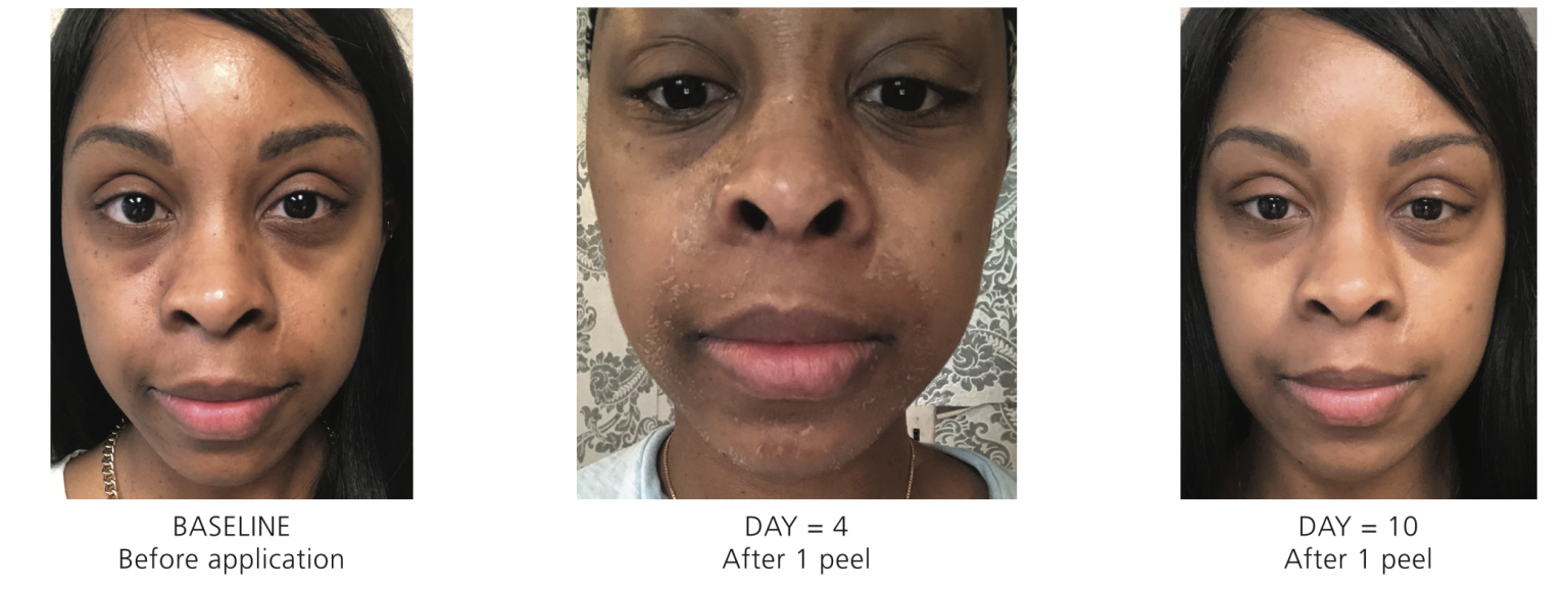 Treatment Focus: Prodigy Peel System – iS Clinical Order