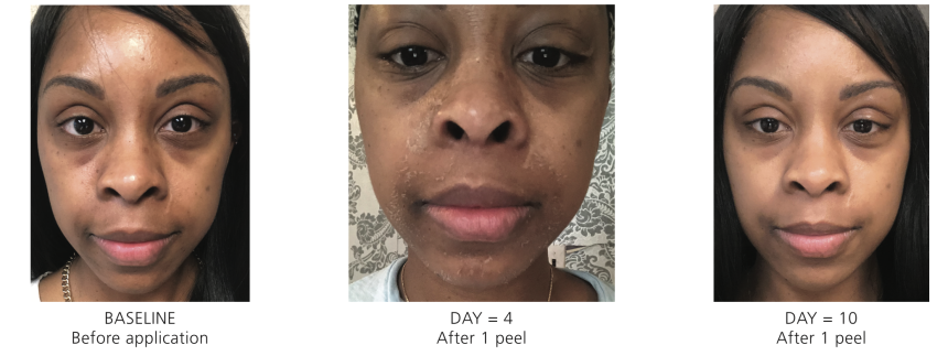 Treatment Focus: Prodigy Peel System – iS Clinical Order